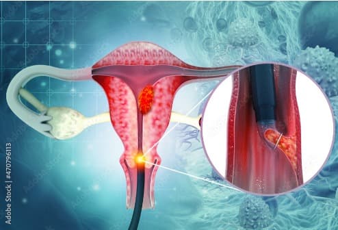 Dilation and Curettage (D&C)|NurtureLife Women Care